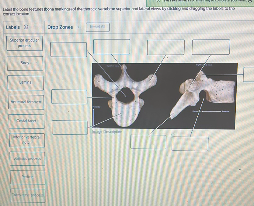 Label the Bone Features (bone Markings) of the Thoracic Vertebrae ...